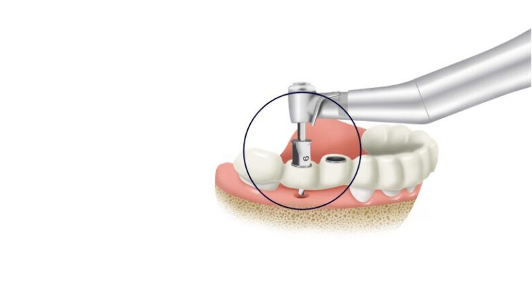 Adinguide™ - Adin Guided Surgery